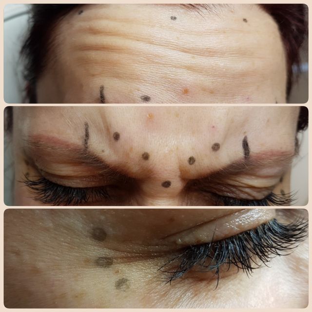 Facial line softening | Lincoln Aesthetic | Dermal Fillers | Lincoln ...