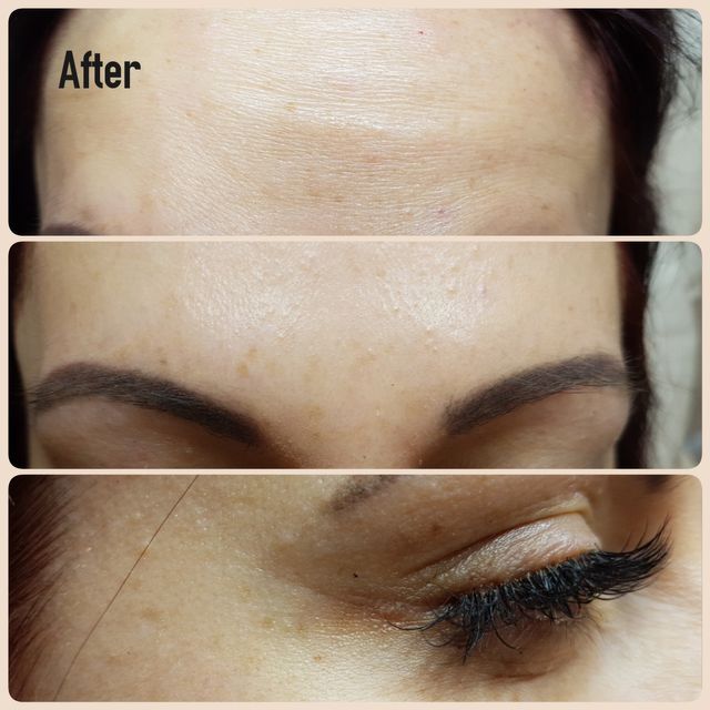 Facial line softening | Lincoln Aesthetic | Dermal Fillers | Lincoln ...