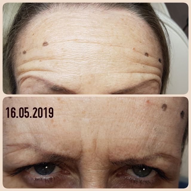 Facial line softening | Lincoln Aesthetic | Dermal Fillers | Lincoln ...
